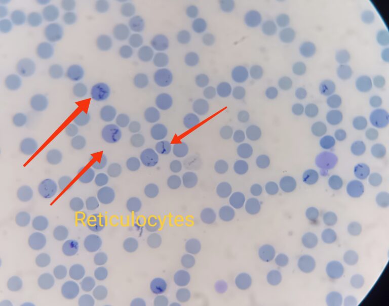 Reticulocyte Count - Procedure, Corrected Reticulocyte Count - Clinical ...