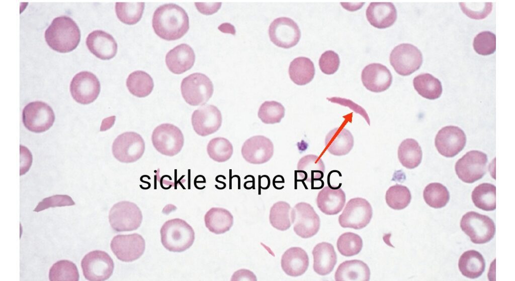 Sickling Test |Sickling Test Procedure - Clinical Laboratory Guide